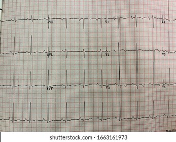 Close Ekg Paper Show Normal Sinus Stock Photo (Edit Now) 1663161973