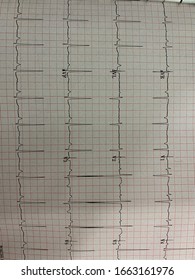 Close Ekg Paper Show Normal Sinus Stock Photo 1663161976 | Shutterstock