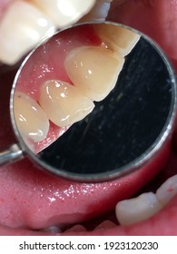 Close Front Teeth Back View After Stock Photo 1923120230 | Shutterstock
