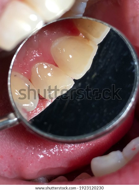 Close Front Teeth Back View After Stock Photo 1923120230 | Shutterstock