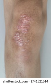 8 Plaque Psoriasis Mild Images, Stock Photos & Vectors | Shutterstock