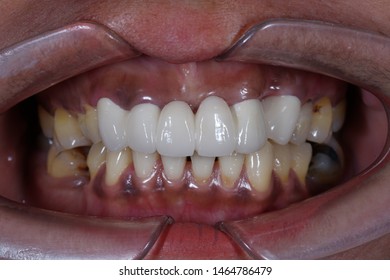 Normal Occlusionfront View Stock Photo 782376487 | Shutterstock