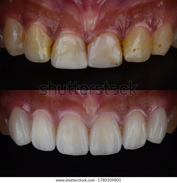 Close Oral Front Teeth Before After Stock Photo (Edit Now) 1780109801
