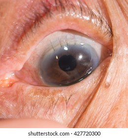 Close Dilated Pupil During Eye Examination Stock Photo 223989844 ...