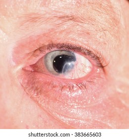 Close Post Traumatic Iris Lost Corneal Stock Photo 383893456 | Shutterstock