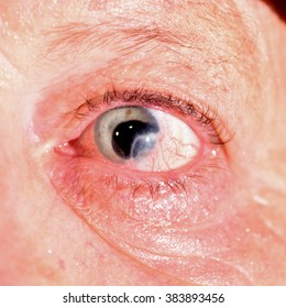 58 Corneal scarring Images, Stock Photos & Vectors | Shutterstock