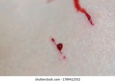 117 Superficial wound Images, Stock Photos & Vectors | Shutterstock