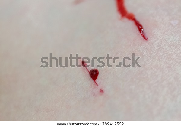 Close Skin Damage Bleeding Background Stock Photo 1789412552 | Shutterstock