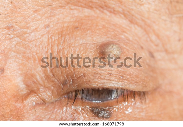 Close Skin Tag Left Upper Eyelid Stock Photo 168071798 | Shutterstock
