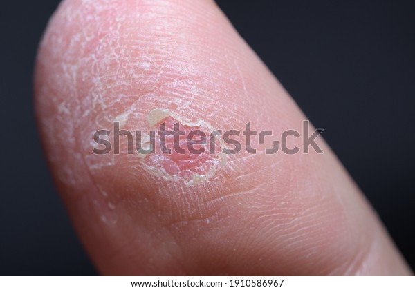 Close Thumb Dermatitis Stock Photo (Edit Now) 1910586967