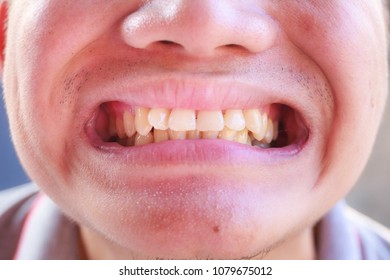 On Gum Abscess Formed Tumor Purulent Stock Photo (Edit Now) 1898272417