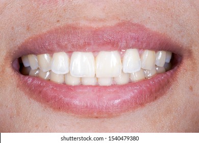 9,915 imágenes de Upper teeth - Imágenes, fotos y vectores de stock ...