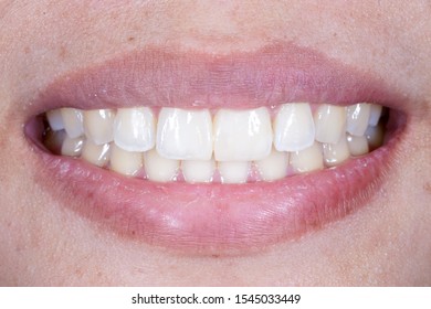 B1 Color Hollywood Smile Veneers Stock Photo 1164176749 | Shutterstock