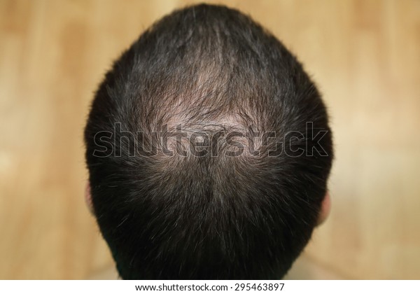 Closeup Background Bald Head Stock Photo (Edit Now) 295463897