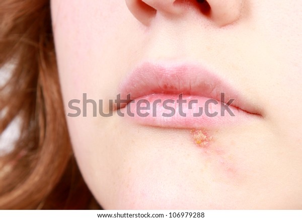 Closeup Common Cold Sore Virus Herpes Stock Photo (Edit Now) 106979288