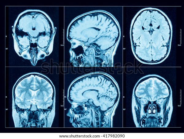 Closeup Ct Scan Brain Stock Photo 417982090 | Shutterstock