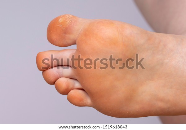 Closeup View On Underside Human Foot Stock Photo (Edit Now) 1519618043