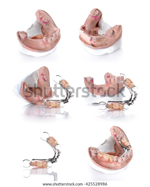 Collection Denture Moldfalse Teeth Isolated On Stock Photo 425528986 ...