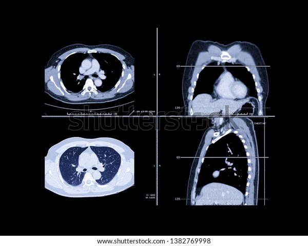 Comparison Ct Chest Contrast Media Axial Stock Photo (Edit Now) 1382769998 Comparison Ct Chest Contrast Media Axial Stock Photo (Edit Now) 1382769998