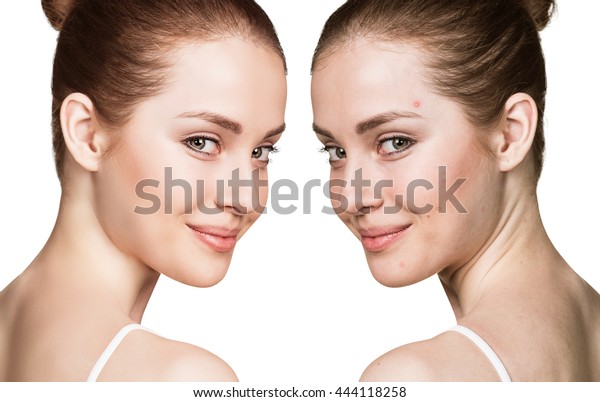 Comparison Portrait Problematic Skin Stock Photo (Edit Now) 444118258