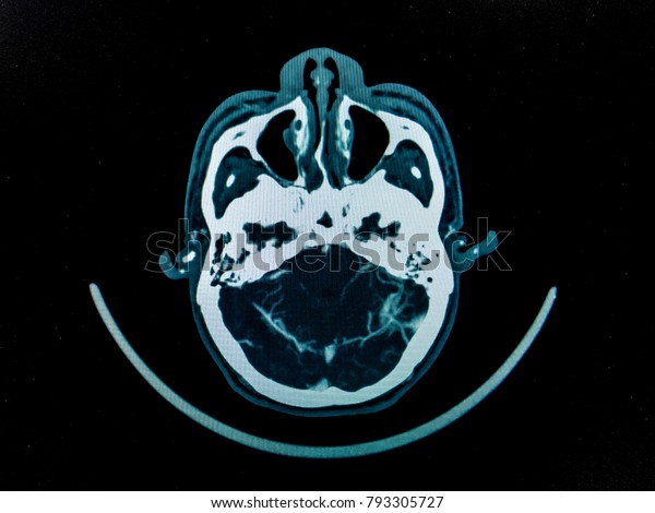 Computed Tomography Brain Ct Brain Background Stock Photo 793305727 ...