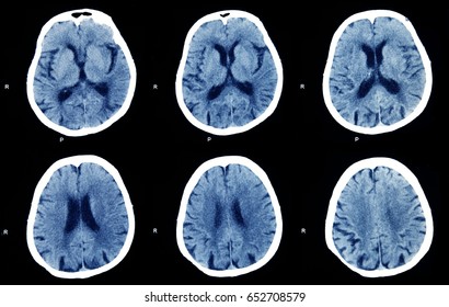 12,114 Ct brain Images, Stock Photos & Vectors | Shutterstock