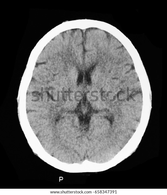 Computed Tomography Ct Brain Stock Photo (Edit Now) 658347391