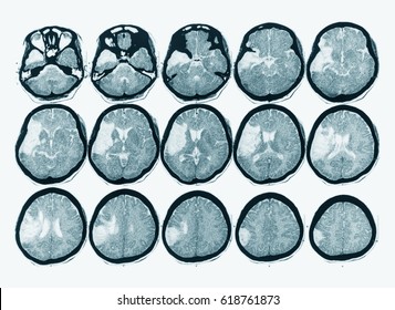Computed Tomography Ct Brain Case Cerebrovascular Stock Photo 618761873 ...