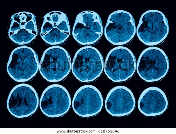 Computed Tomography Ct Brain Case Cerebrovascular库存照片618761846 ...