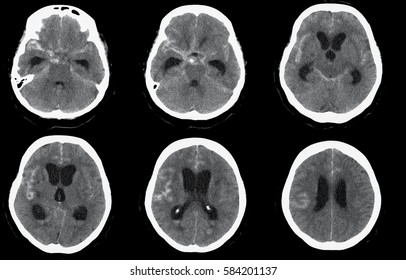 313 Cerebral fissure Images, Stock Photos & Vectors | Shutterstock