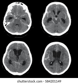 Computed Tomography Ct Brain Diffuse Sah Foto Stok 584201149 | Shutterstock