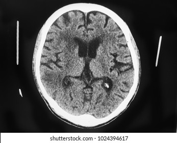 Стоковая фотография 1005992140: Sagittal Plain Transverse Cut Ct Scan ...