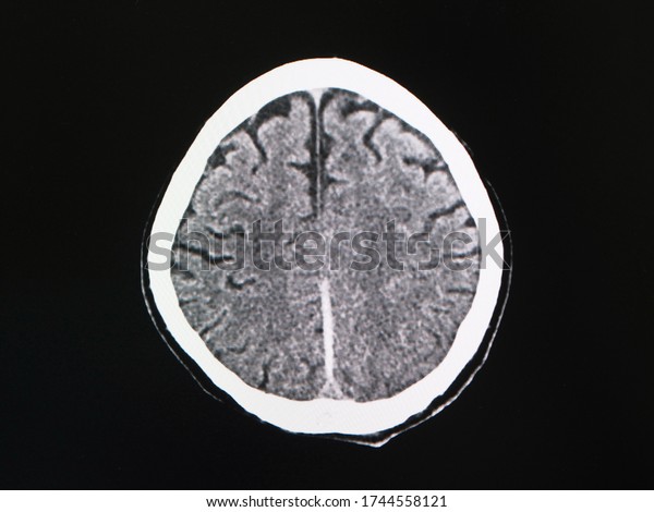 Computer Tomography Brain Showed Interhemispheric Subdural Stock Photo ...