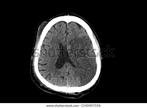 A computer tomography or CT image of brain showing massive ischemic ...