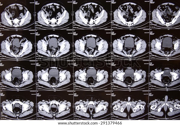 Computerized Axial Tomography Scan Cat Scan Stock Photo (Edit Now ...