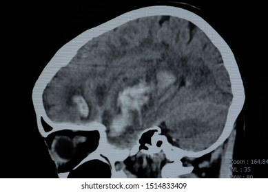 Computerized Tomography Scanct Scan Old Man Stock Photo 1514833409 ...