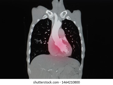 Coronal View Computer Tomography Ct Scan Stock Photo 1464210800 ...