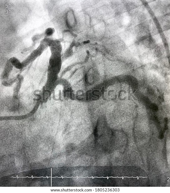 Coronary Angiogram Shown Diffuse Coronary Ectasia Stock Photo ...