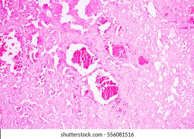 Photomicrograph Glomangioma Skin Type Glomus Tumor Stock-foto 765364027 ...