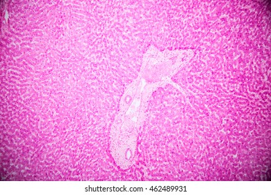 Renal Tuberculosis Light Micrograph Photo Under Stock Photo (Edit Now ...
