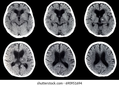 Ct Scan Brain Patient Cerebral Infarction 스톡 사진 1127597855 | Shutterstock