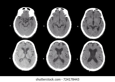 Ct Brain Stock Photo 724178443 | Shutterstock