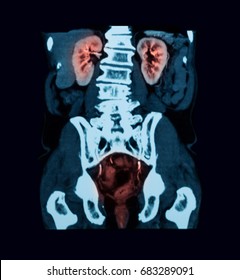 Ct Computed Tomography Urinary System Urinary Stock Photo 683289091 ...