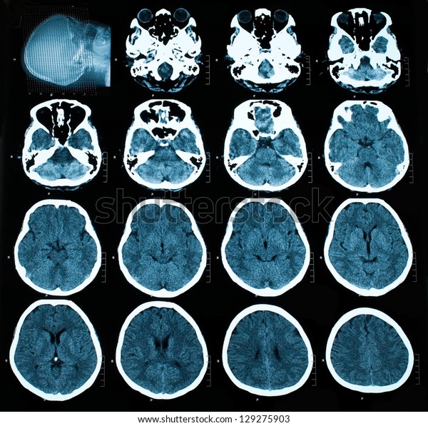 Ct Scan Brain Stock Photo 129275903 | Shutterstock