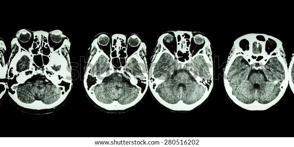 CT scan of brain and base of skull ( show structure of eye , ethmoid ...
