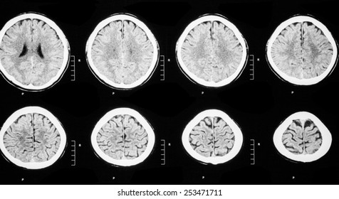 Ct Scan Brain Showing Child Brain Foto Stok 729077371 | Shutterstock