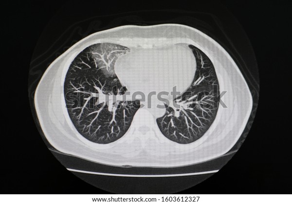 Ct Scan Computed Tomography Chest Organs库存照片1603612327 | Shutterstock Ct Scan Computed Tomography Chest Organs库存照片1603612327 | Shutterstock