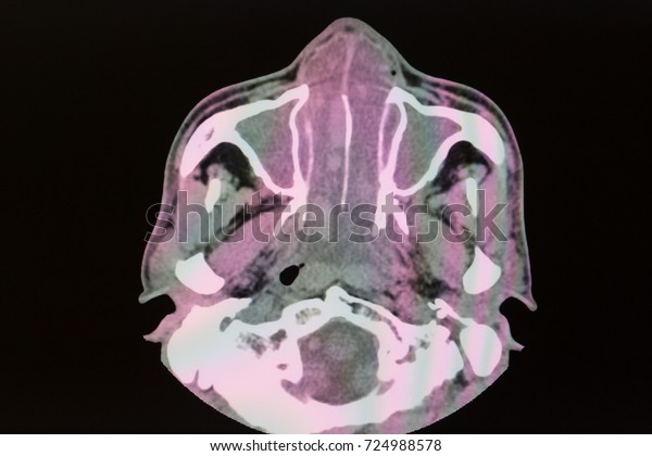 CT scan of the paranasal sinus showing total opacity in all sinuses ... CT scan of the paranasal sinus showing total opacity in all sinuses ...