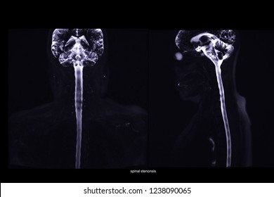 1,326 Spinal cord xray Images, Stock Photos & Vectors | Shutterstock