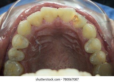 Decayed Tooth Front Teethinner View Stock Photo 780067087 | Shutterstock